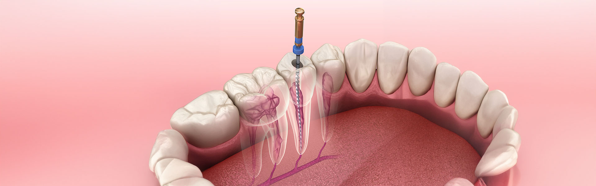 What to Expect After Your Root Canal Procedure?